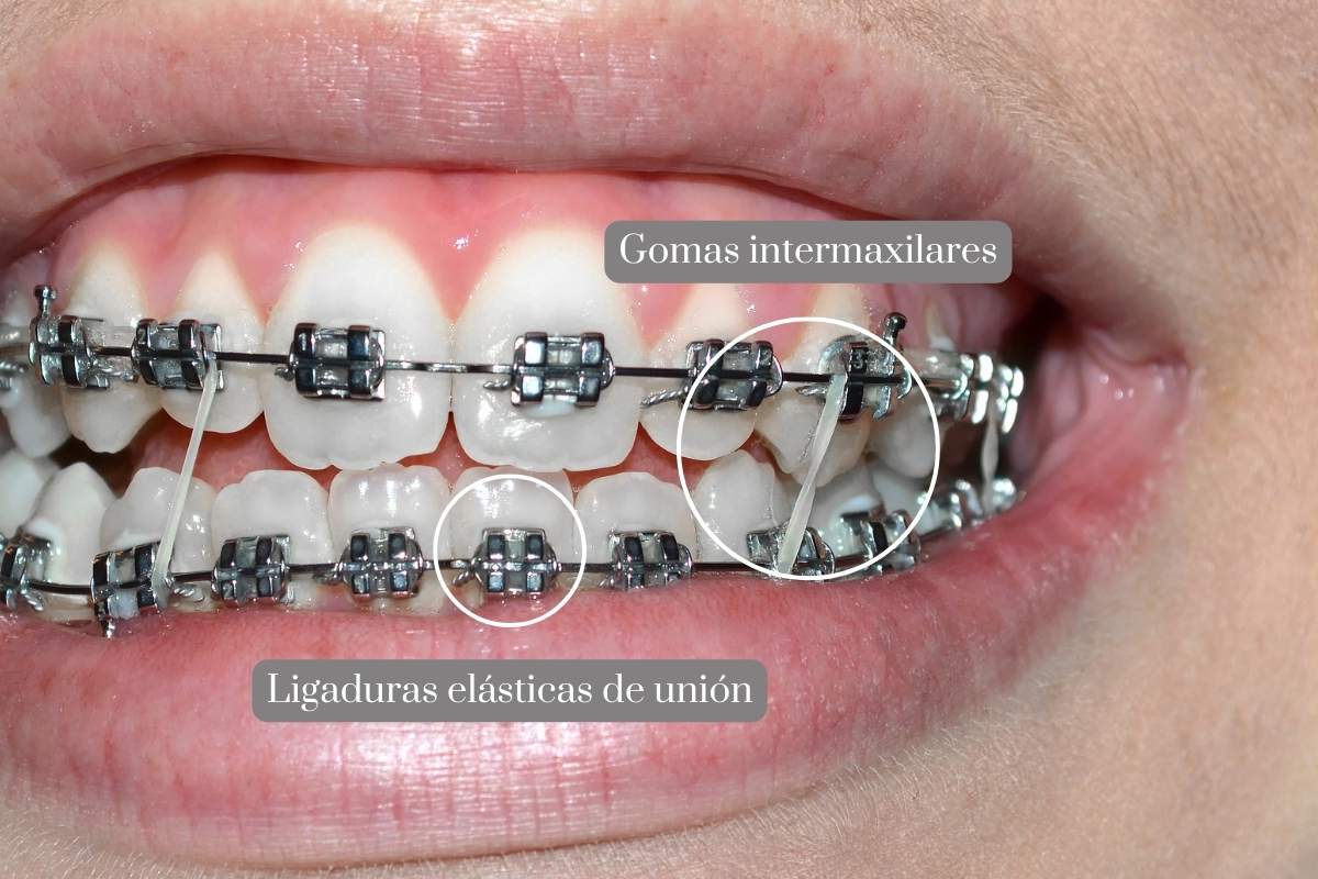 ¿Para qué sirven las gomas de los brackets? - Loscos Ortodoncia