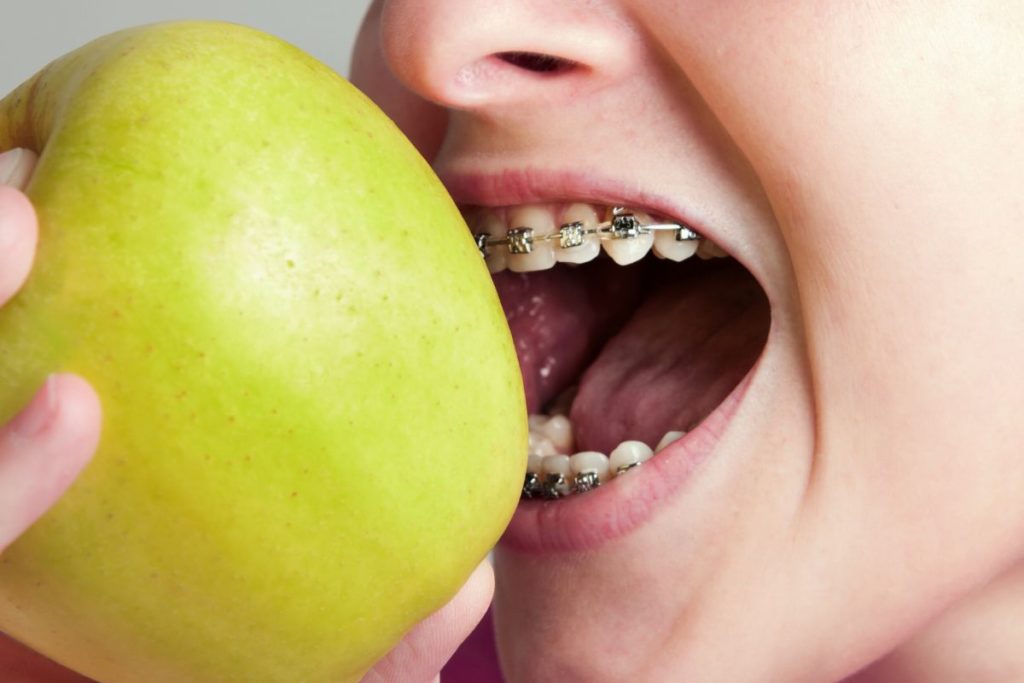 ¿Qué no se puede comer con brackets? - Loscos Ortodoncia